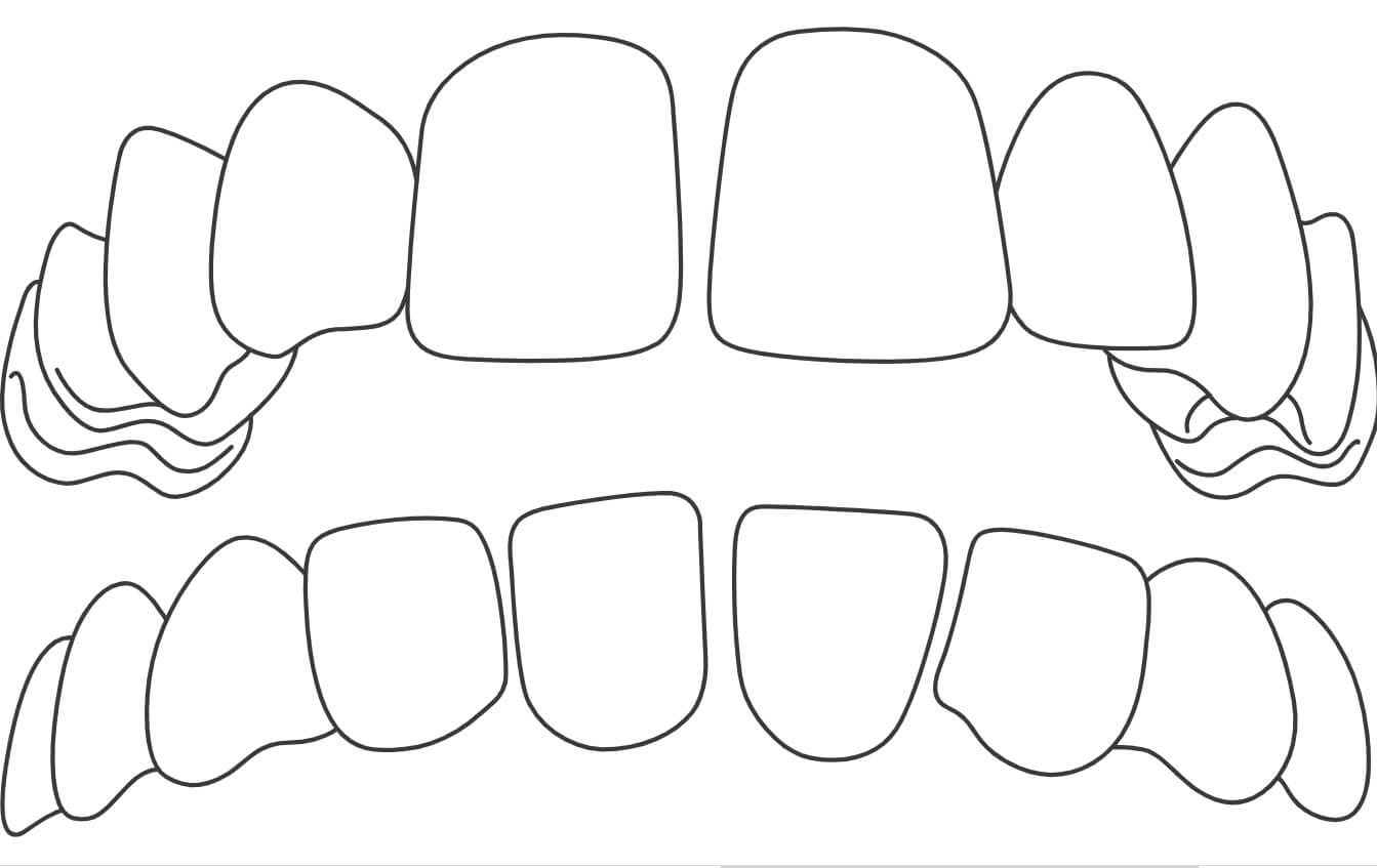 Ορθοδοντική Θεραπεία Invisalign. Τι είναι, πόσο κοστίζει, τι θεραπεύει ...